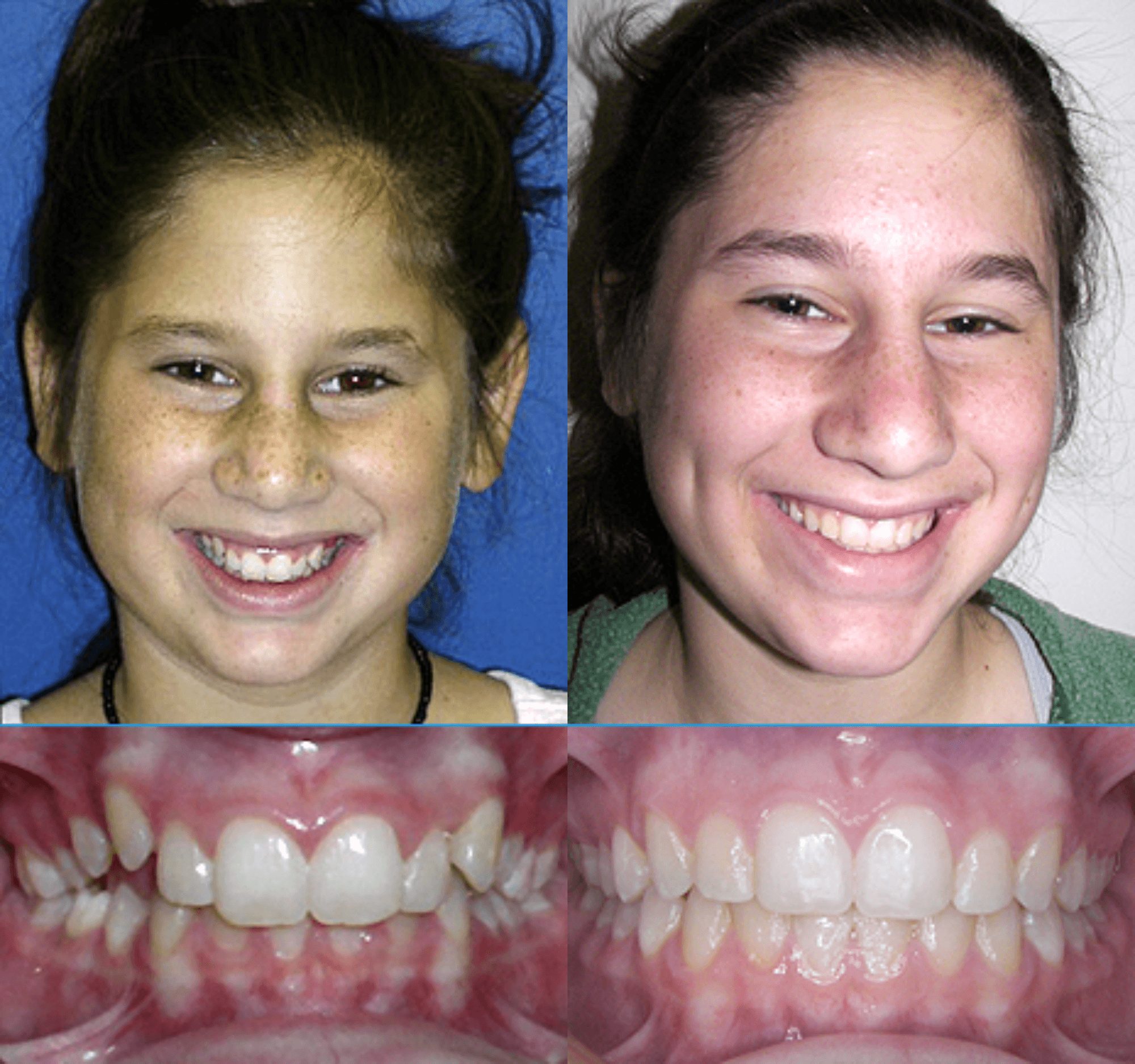 Braces Gallery | Stavisky Orthodontics | Metal Braces | Clear Braces
