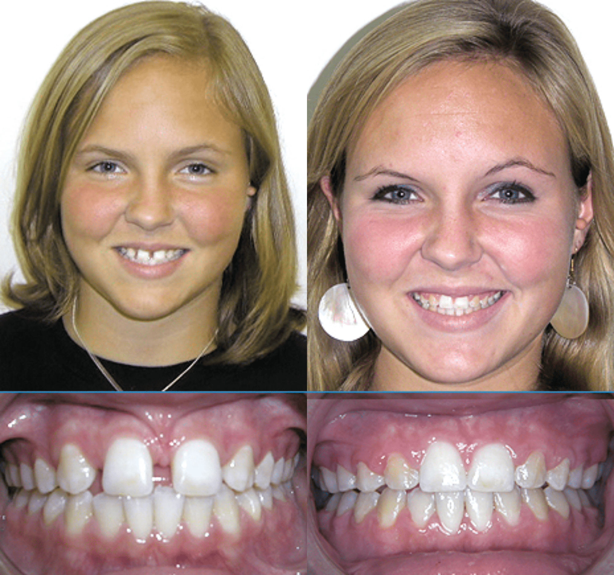 Braces Gallery | Stavisky Orthodontics | Metal Braces | Clear Braces
