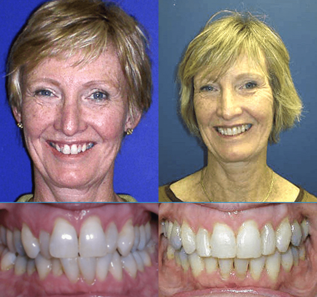 Braces Gallery | Stavisky Orthodontics | Metal Braces | Clear Braces