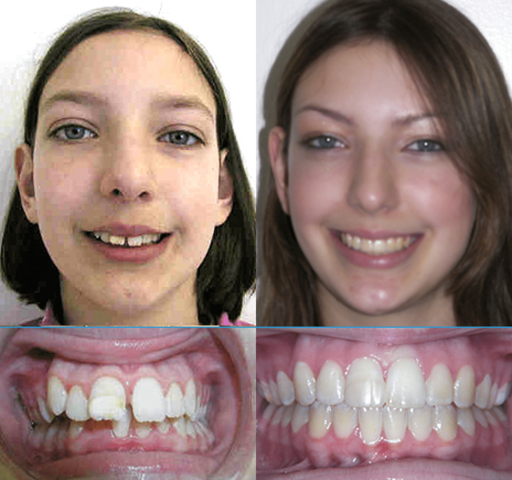 Braces Gallery | Stavisky Orthodontics | Metal Braces | Clear Braces