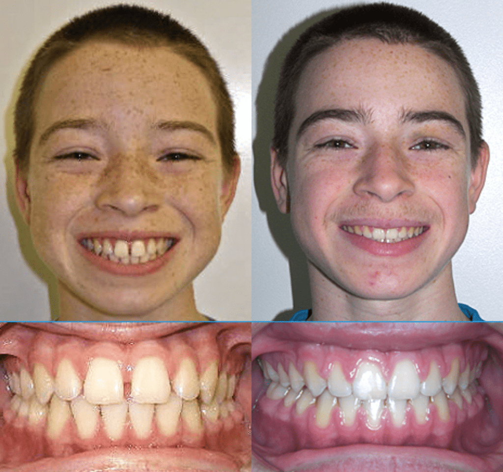 Braces Gallery | Stavisky Orthodontics | Metal Braces | Clear Braces