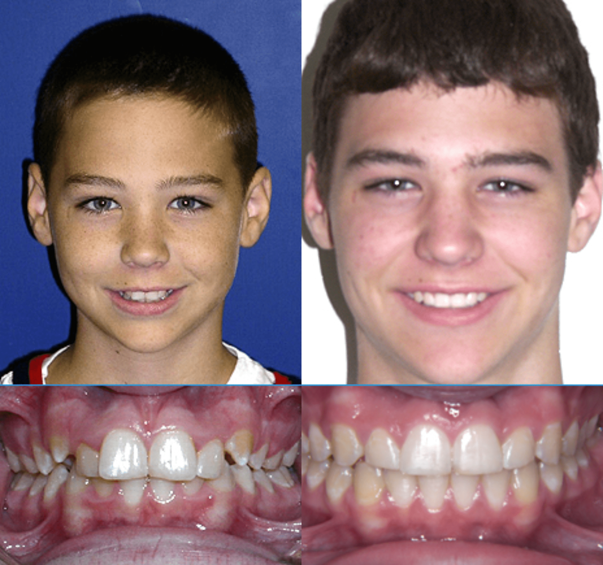 Braces Gallery | Stavisky Orthodontics | Metal Braces | Clear Braces
