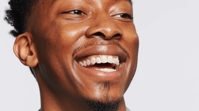 LightForce Clear Braces | Stavisky Orthodontics | Clear Braces