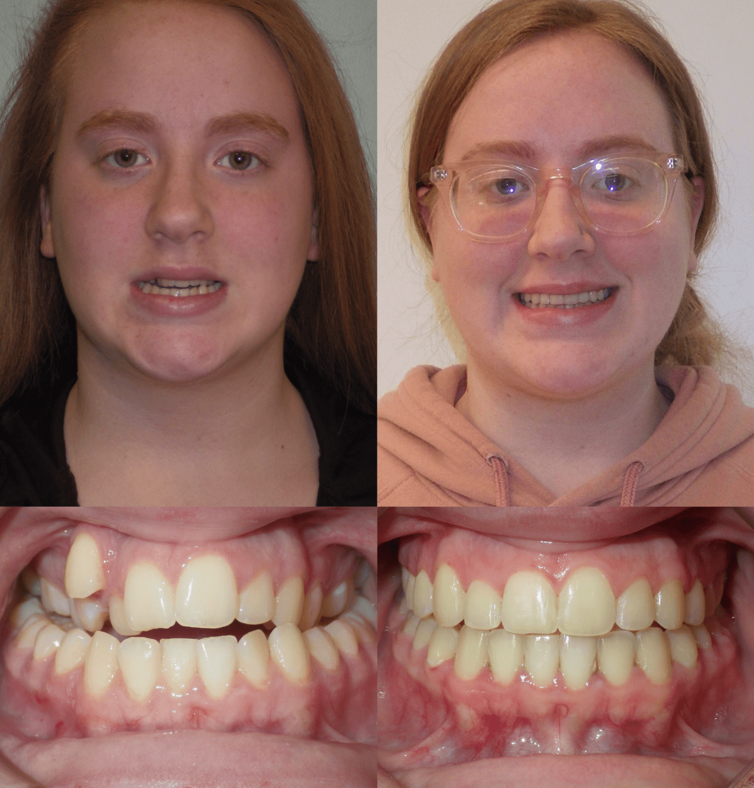 Orthodontic Before & Afters | Stavisky Orthodontics