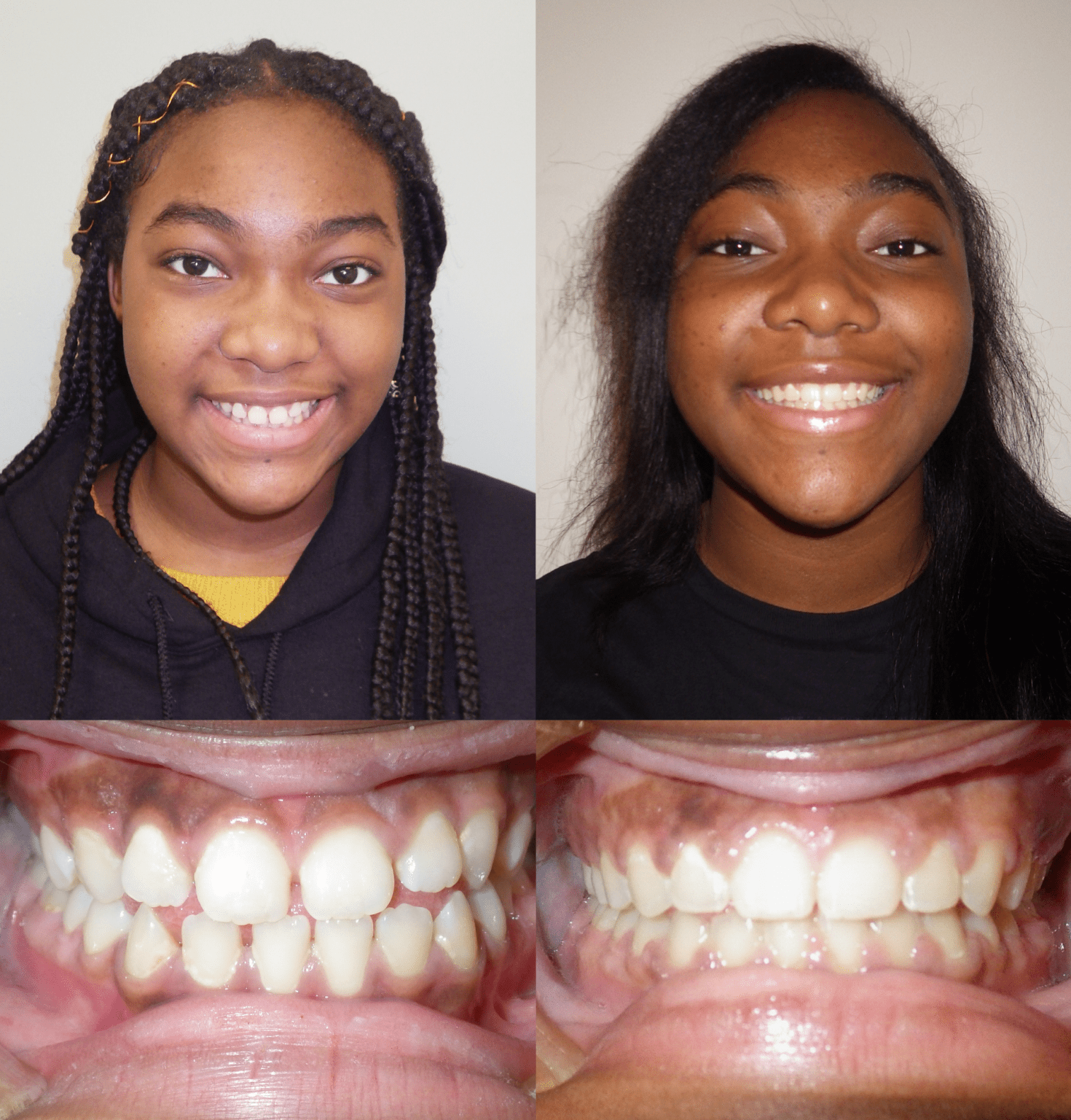Orthodontic Before & Afters | Stavisky Orthodontics