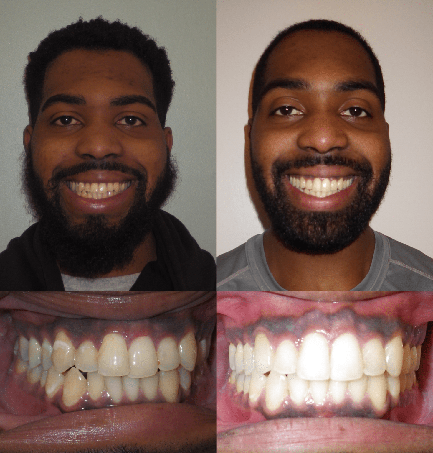 Orthodontic Before & Afters | Stavisky Orthodontics